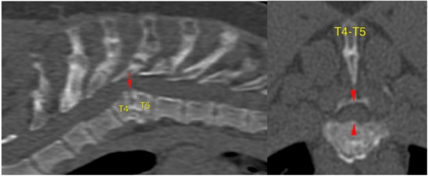 Burgess Diagnostics Ltd - CT: CT imaging used to identify Osteopenia and fractures